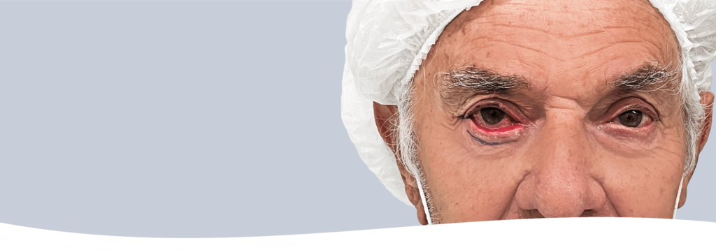 Ectrópio, Entrópio e Triquíase - Dr. Gustavo Ludwig - Plástica ocular ...